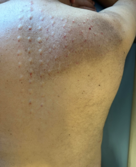 NOTALGIA PARESTESICA CURATA CON LA NEURALTERAPIA - Airas